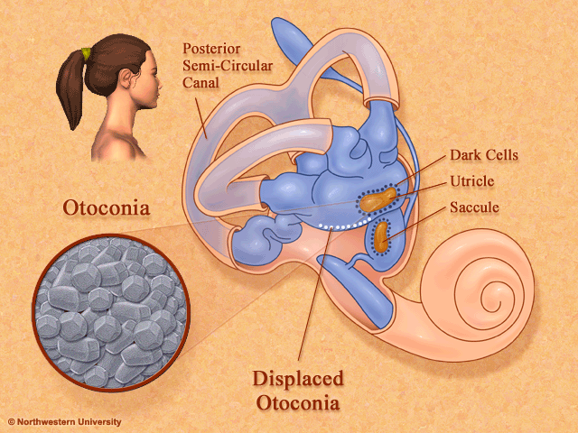 Vértigo postural - EcuRed