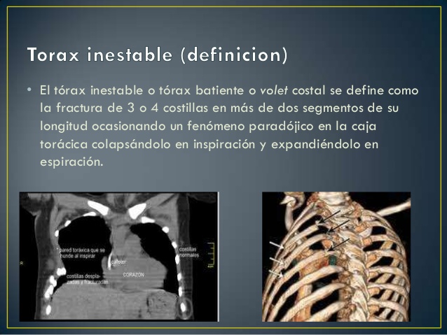 Bamboleo torácico en el niño - EcuRed