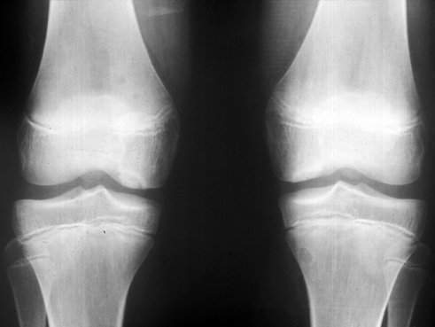 Osteocondritis disecante - EcuRed