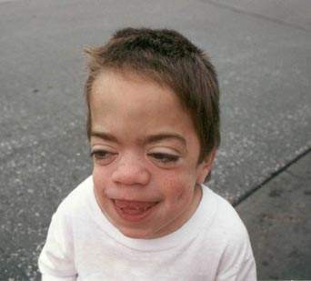 Macrocefalia - EcuRed