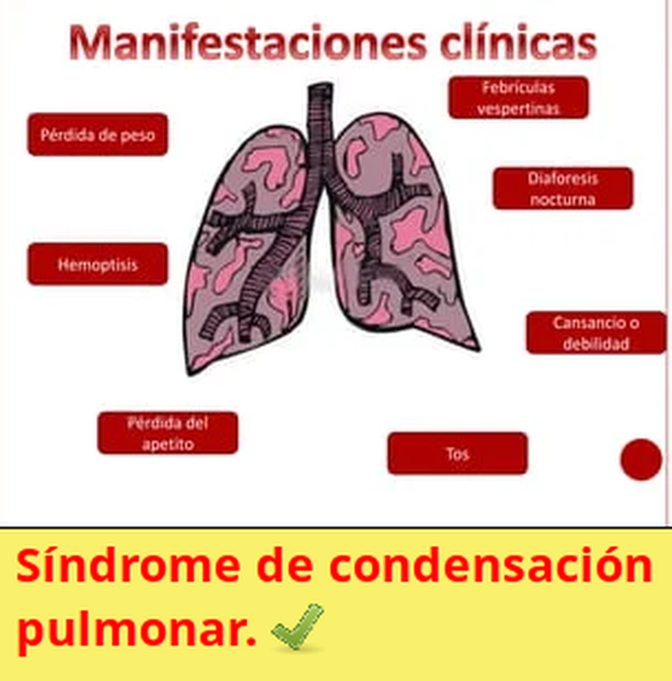 Condensación pulmonar - EcuRed