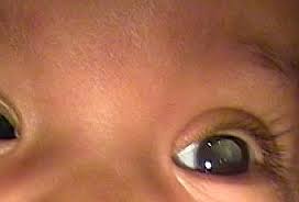 Retinopatía de la prematuridad o fibroplasia retrolental - EcuRed