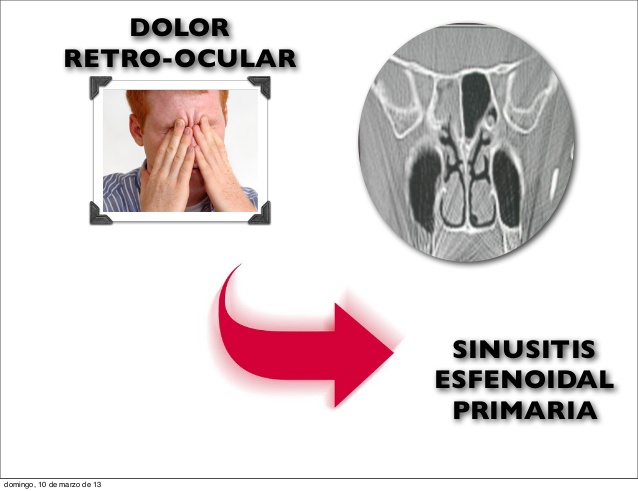 Sinusitis esfenoidal aguda - EcuRed