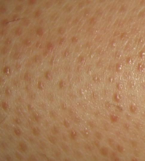Queratosis pilaris - EcuRed