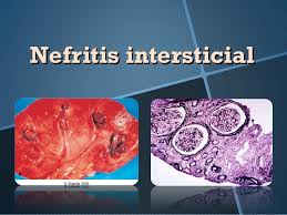 Nefritis tubulointersticial aguda - EcuRed