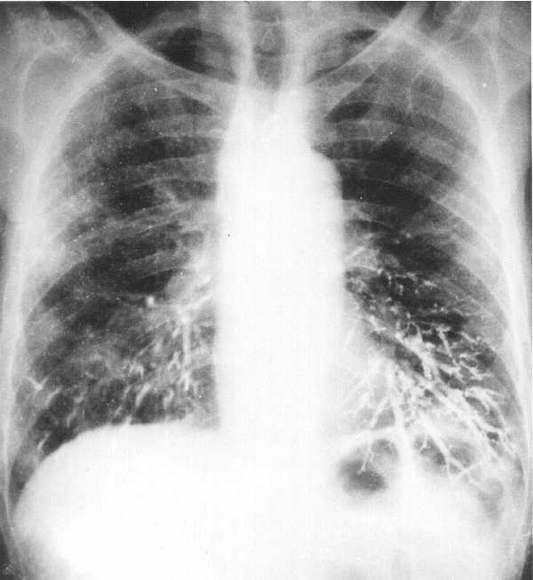 Perforación esofágica - EcuRed