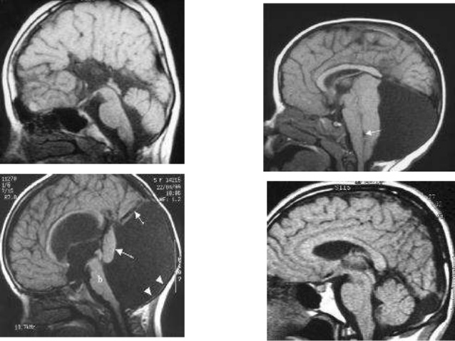 Síndrome de Dandy-Walker - EcuRed