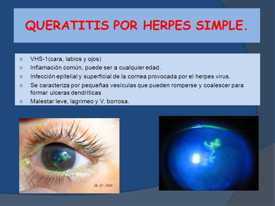 Queratitis por herpes simple - EcuRed