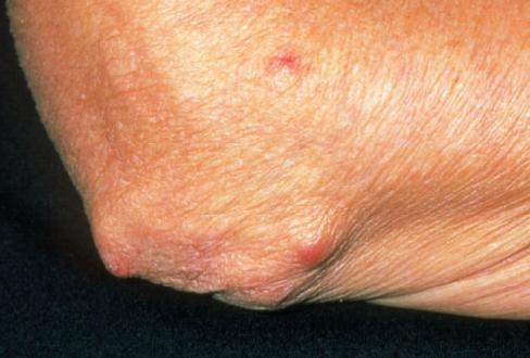 Síndrome de Felty - EcuRed