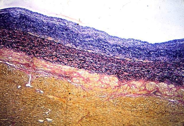 Fibroelastosis endocárdica - EcuRed