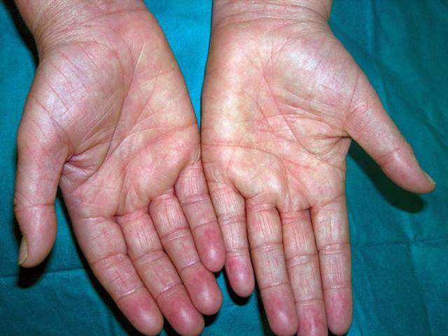 Hiperqueratosis - EcuRed
