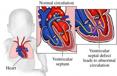 Defecto septal ventricular - EcuRed