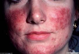 Acné rosácea - EcuRed