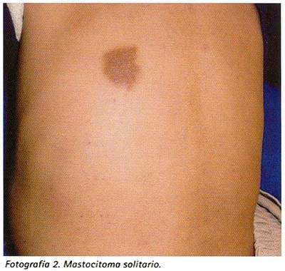 Mastocitosis cutáneas - EcuRed