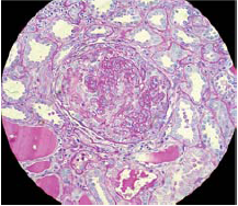 Glomerulonefritis rápidamente progresiva - EcuRed