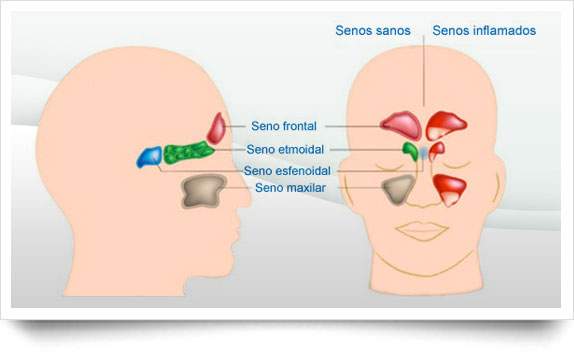 Sinusitis esfenoidal crónica - EcuRed