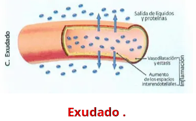 Exudado serofibrinoso - EcuRed
