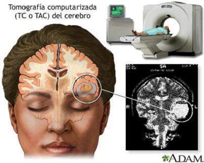 Tomografía axial computarizada (TAC) - EcuRed