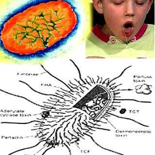 Tos ferina en niños - EcuRed
