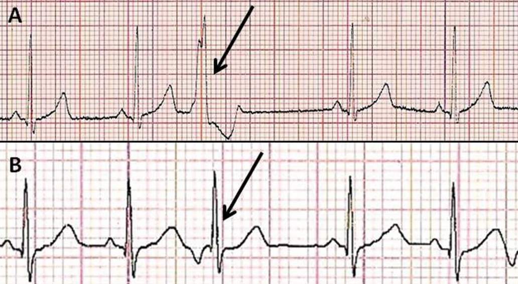 Extrasístole - EcuRed