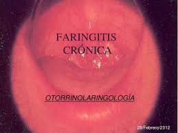 Faringitis crónica - EcuRed