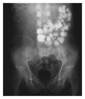 Nefrocalcinosis - EcuRed