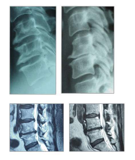 Espondiloartrosis - EcuRed