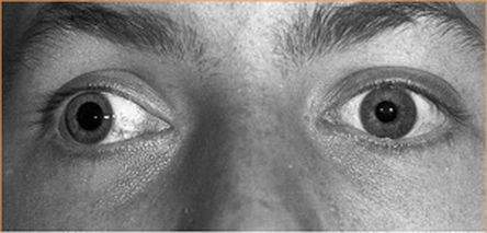 Síndrome de Claude Bernard Horner - EcuRed