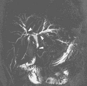 Colangitis esclerosante primaria - EcuRed