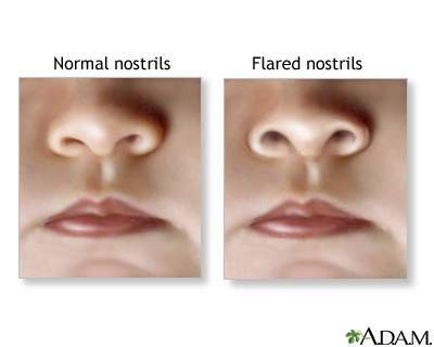 Aleteo nasal - EcuRed