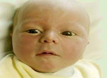 Ictericia neonatal - EcuRed