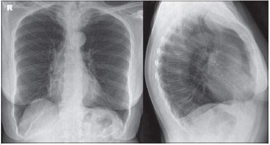 Linfangioleiomiomatosis - EcuRed