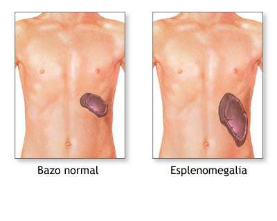 Esplenomegalia Ecured