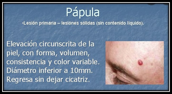 Pápula Lesión O Tumor Eruptivo De Piel Ecured