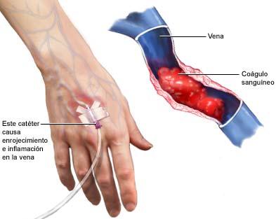Tromboflebitis superficial - EcuRed