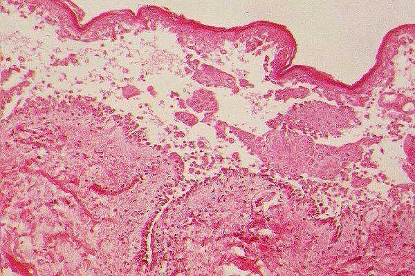 Histologia Do Penfigo Vulgar