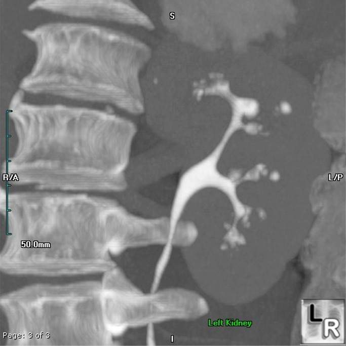 Necrosis papilar renal - EcuRed