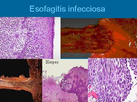 Esofagitis infecciosa - EcuRed