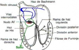 Electrograma Del Haz De His Ecured
