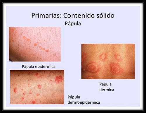 Pápula Lesión O Tumor Eruptivo De Piel Ecured