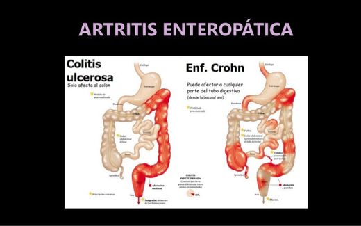 Artritis enteropáticas - EcuRed