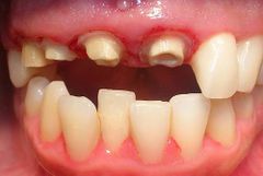 Coronas Provisorias - EcuRed