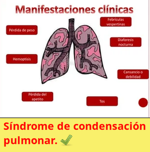 Condensación pulmonar - EcuRed