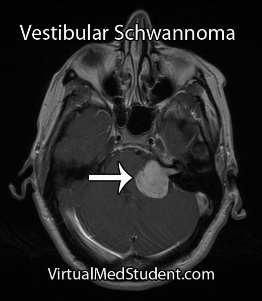 Schwannomas - EcuRed