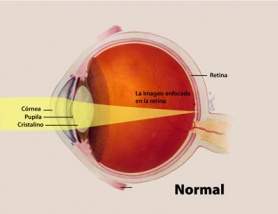 Glaucoma de Ángulo Abierto - EcuRed