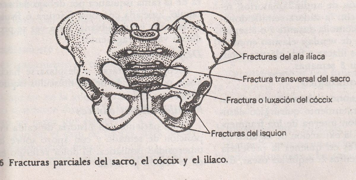 Fractura del ala ilíaca - EcuRed