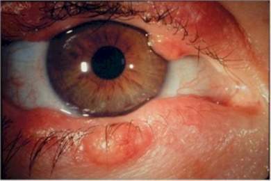 Blefaritis Ciliar - EcuRed
