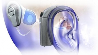 Implante coclear - EcuRed
