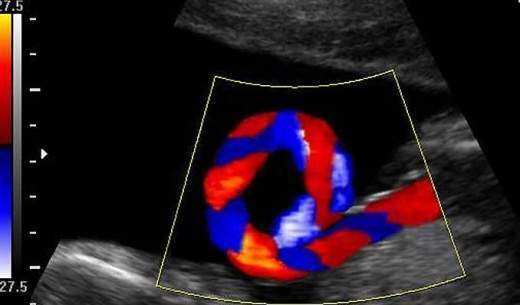 Ultrasonido Doppler - EcuRed