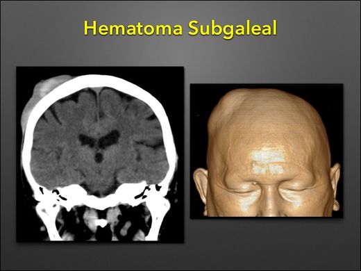 Hematoma Subgaleal - EcuRed